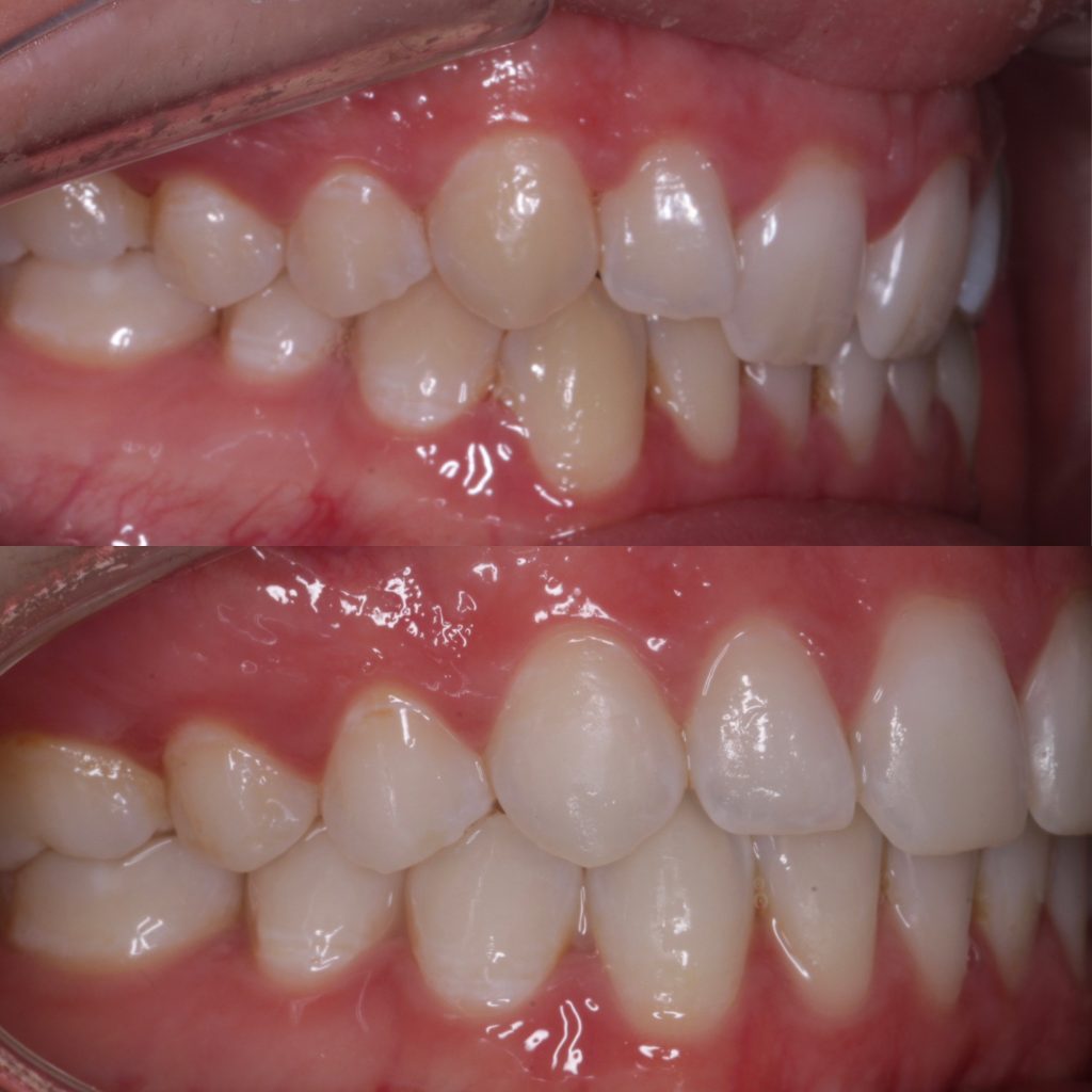 Invisalign - HillaryStreetDental
