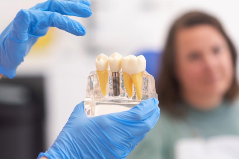 Implants - HillaryStreetDental